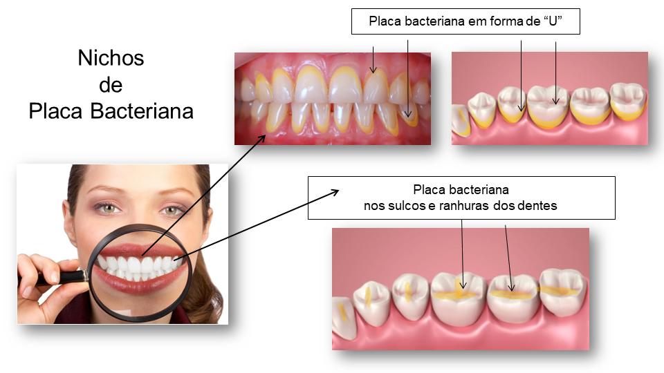 Placa Bacteriana – Orofacial
